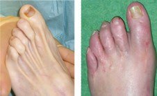 Hammertoe Treatment Sydney | Foot Deformities Treatment Sydney, Newtown